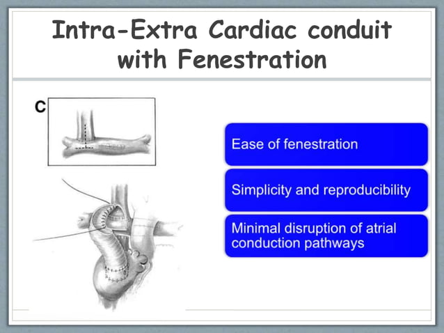 Fontan circulation | PPTX