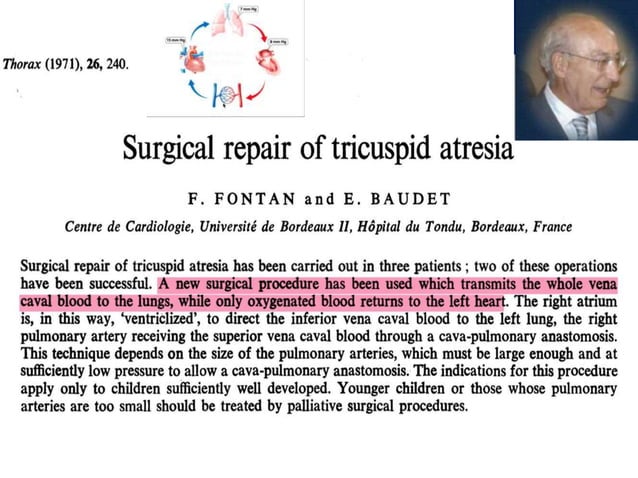 Fontan circulation | PPTX