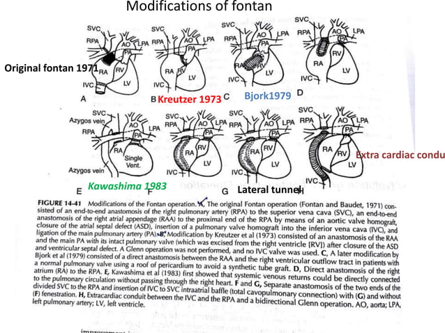 Fontan circulation | PPTX