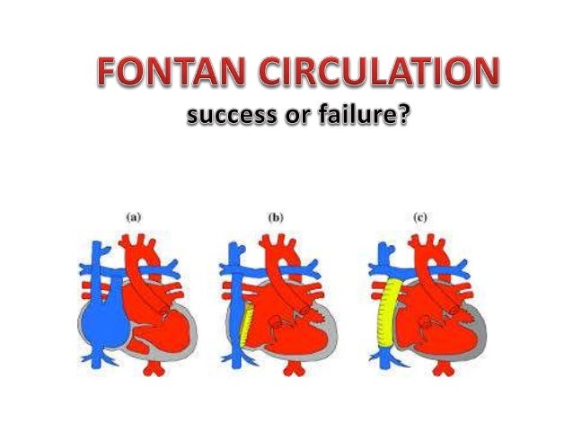 Fontan Procedure Diagram