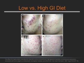 Food & Acne: Myth or Facts??? | PPTX
