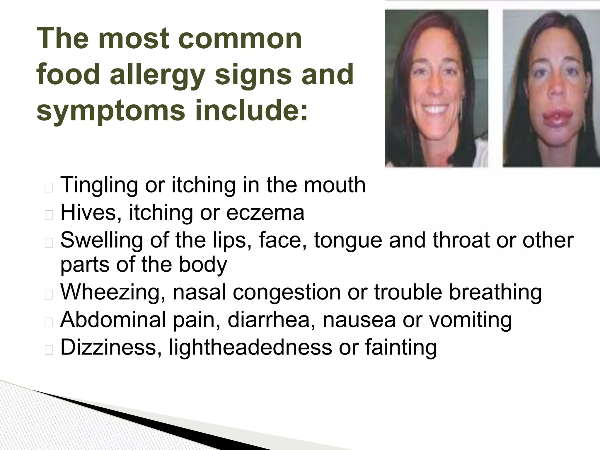 food allergy.pptx