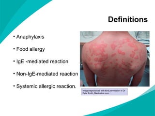 food allergy child and young person presentation | PPT