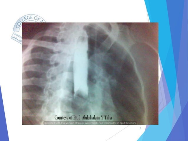 Food Bolus Impaction with Severe Dysphagia.pdf
