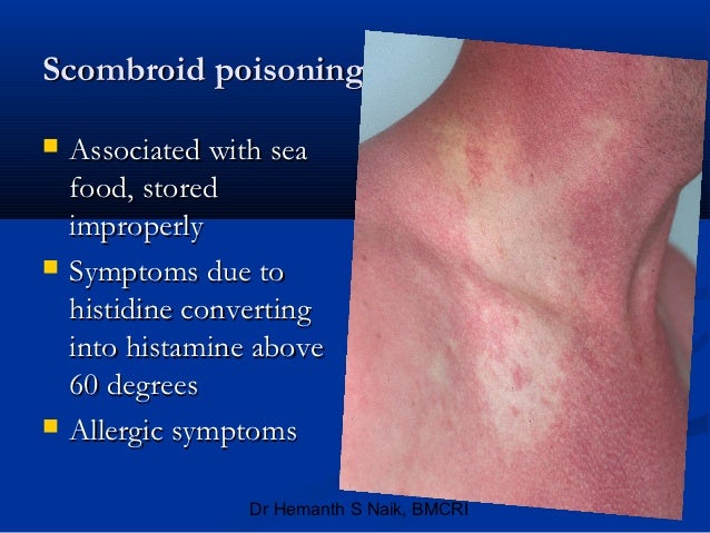 Scombroid Food Poisoning