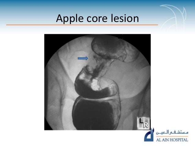 Food signs in radiology pp ta