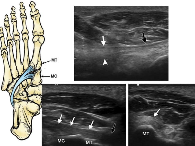 Musculoskeletal Ultrasound examination of the Foot | PPT