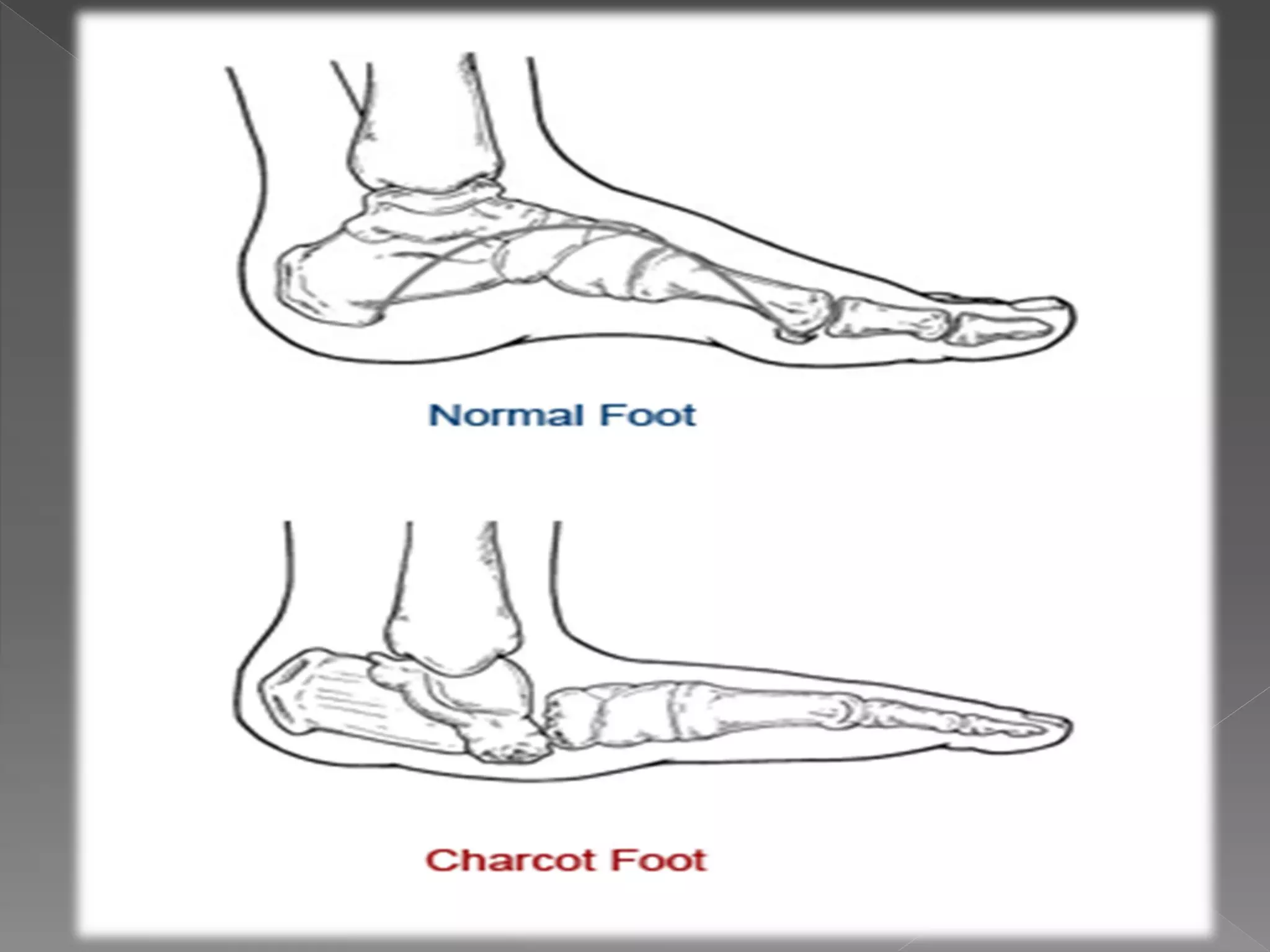 Foot Deformities | PDF