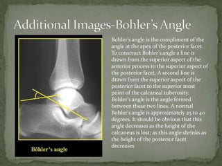 Calcaneus Fracture | PPT