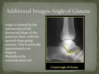 Calcaneus Fracture | PPT