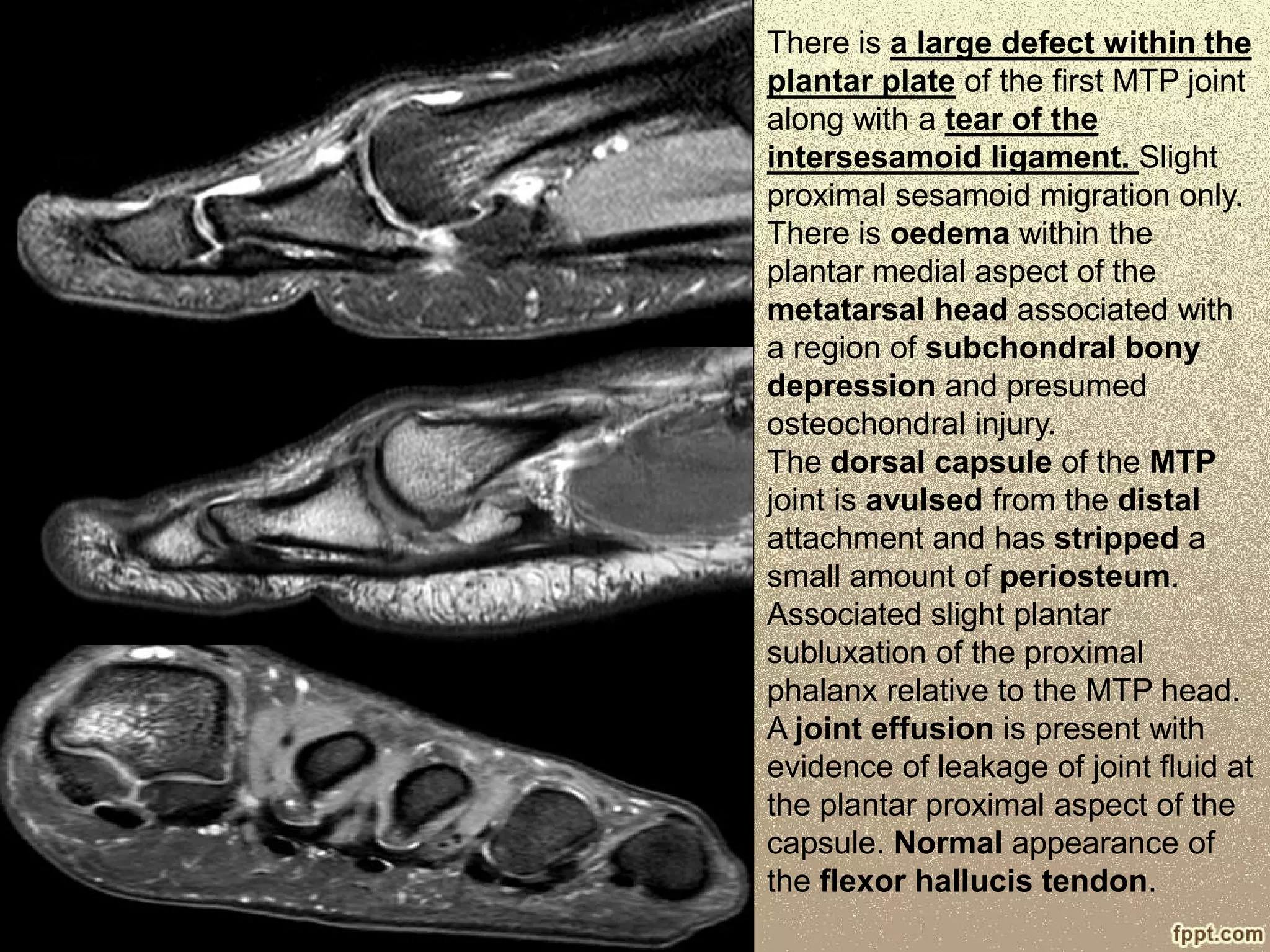 Foot pathology MRI part 1.shorouk zaki | PDF