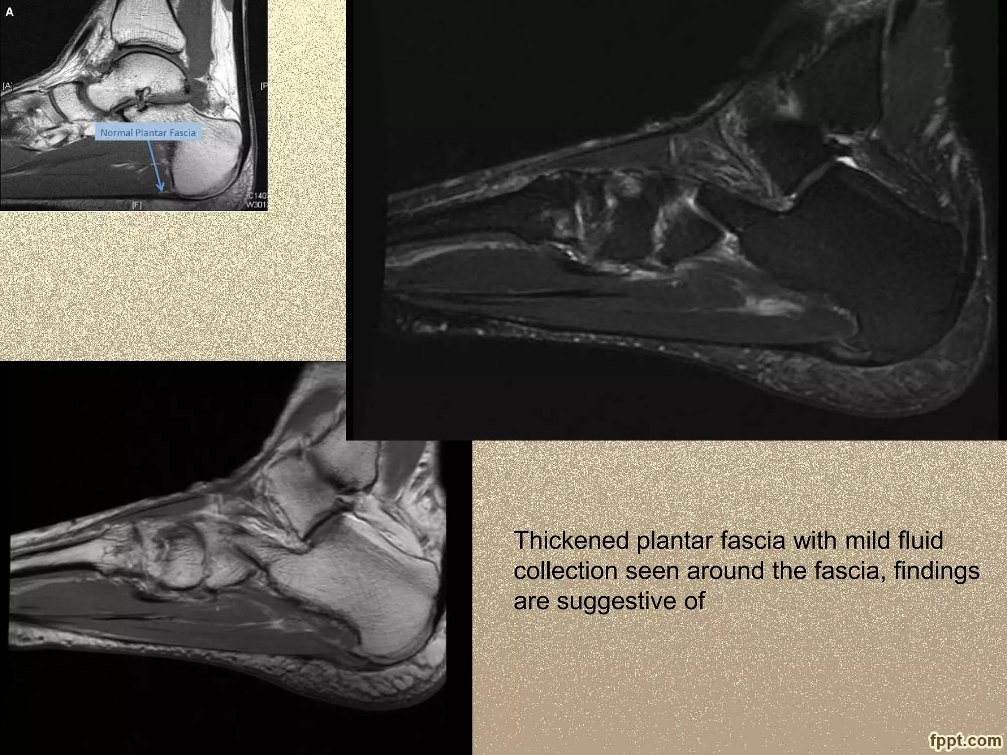 Foot pathology MRI part 1.shorouk zaki | PDF