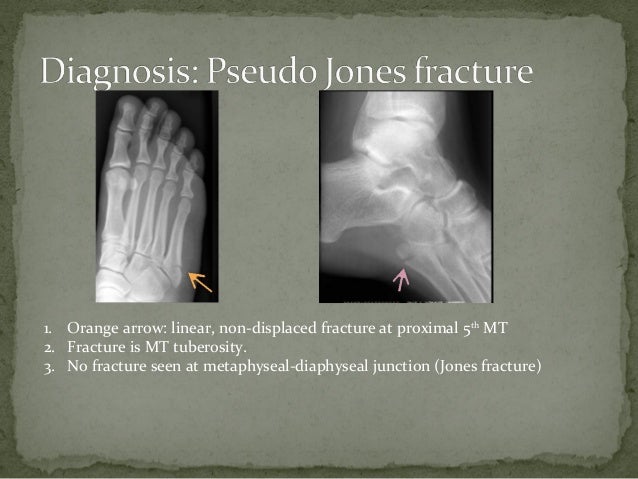 Pseudo Jones Fracture