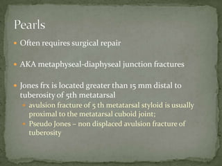 Jones Fracture | PPTX