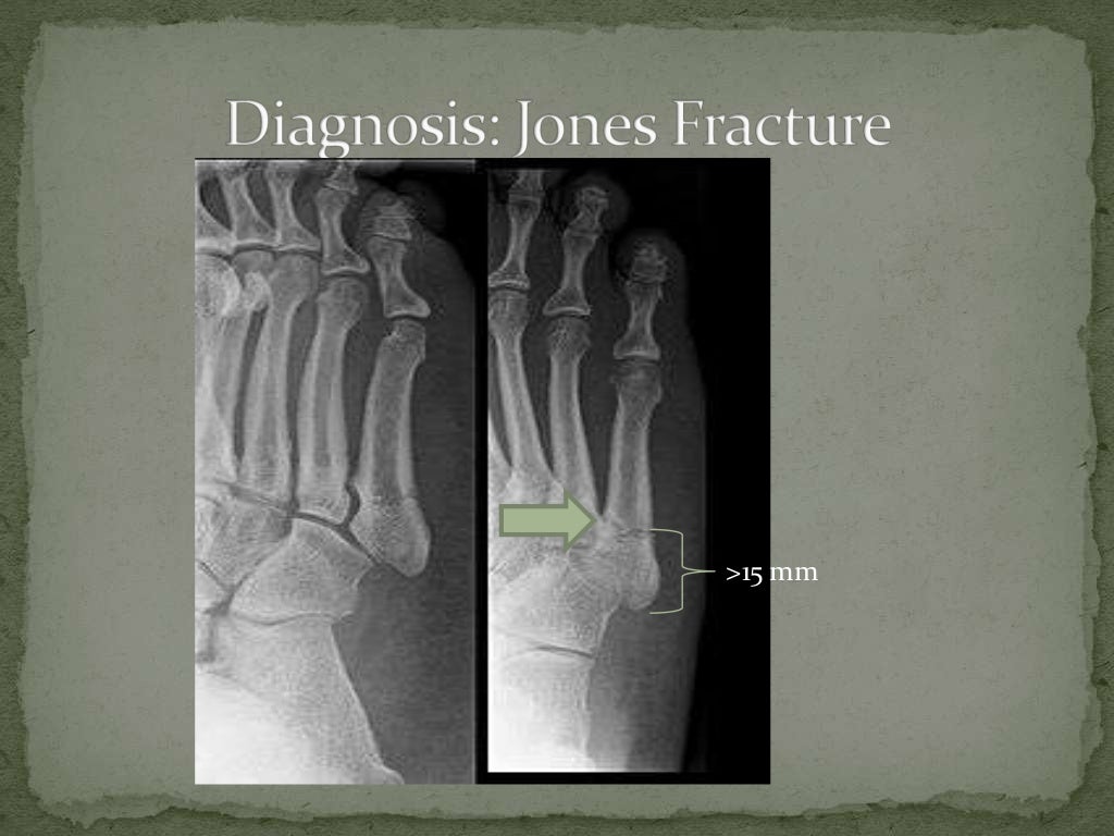 Jones Fracture