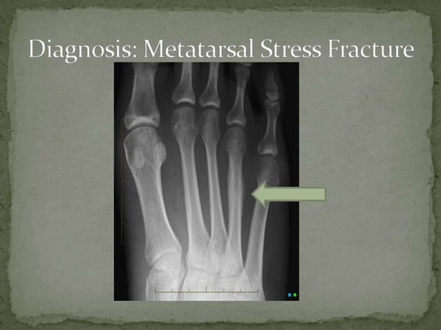 Metatarsal Stress Fracture | PPTX