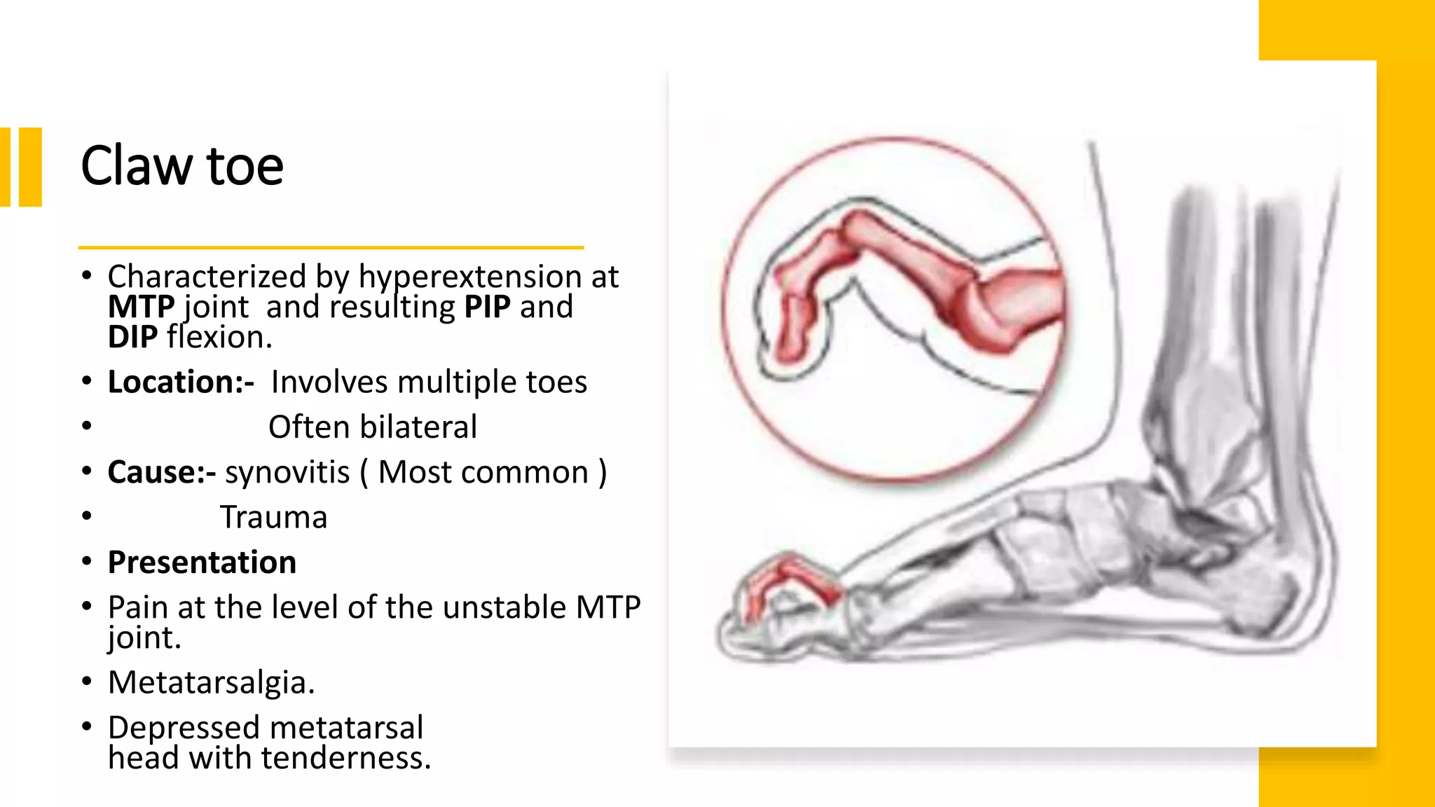 LESSER TOE ABNORMALITIES | PPTX
