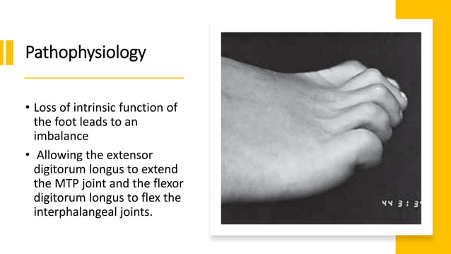 LESSER TOE ABNORMALITIES | PPTX | Death, Injury, or Military Conflict ...