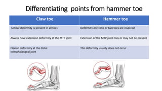 LESSER TOE ABNORMALITIES | PPTX