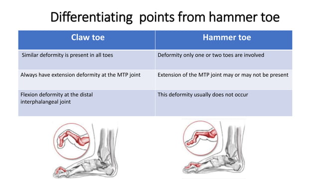 LESSER TOE ABNORMALITIES | PPTX | Death, Injury, or Military Conflict ...
