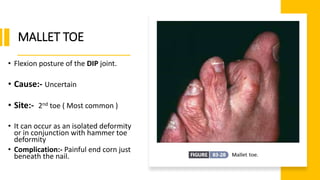 LESSER TOE ABNORMALITIES | PPTX