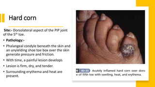 LESSER TOE ABNORMALITIES | PPTX | Death, Injury, or Military Conflict ...