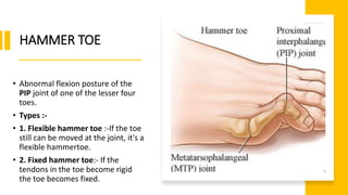 LESSER TOE ABNORMALITIES | PPTX | Death, Injury, or Military Conflict | Sensitive Topics