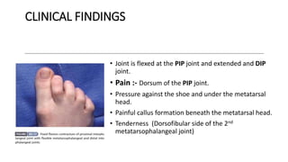 LESSER TOE ABNORMALITIES | PPTX | Death, Injury, or Military Conflict ...