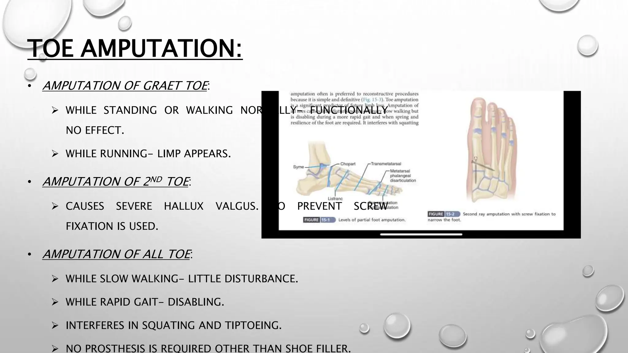 Amputations of foot and it's rehabilitation.pptx