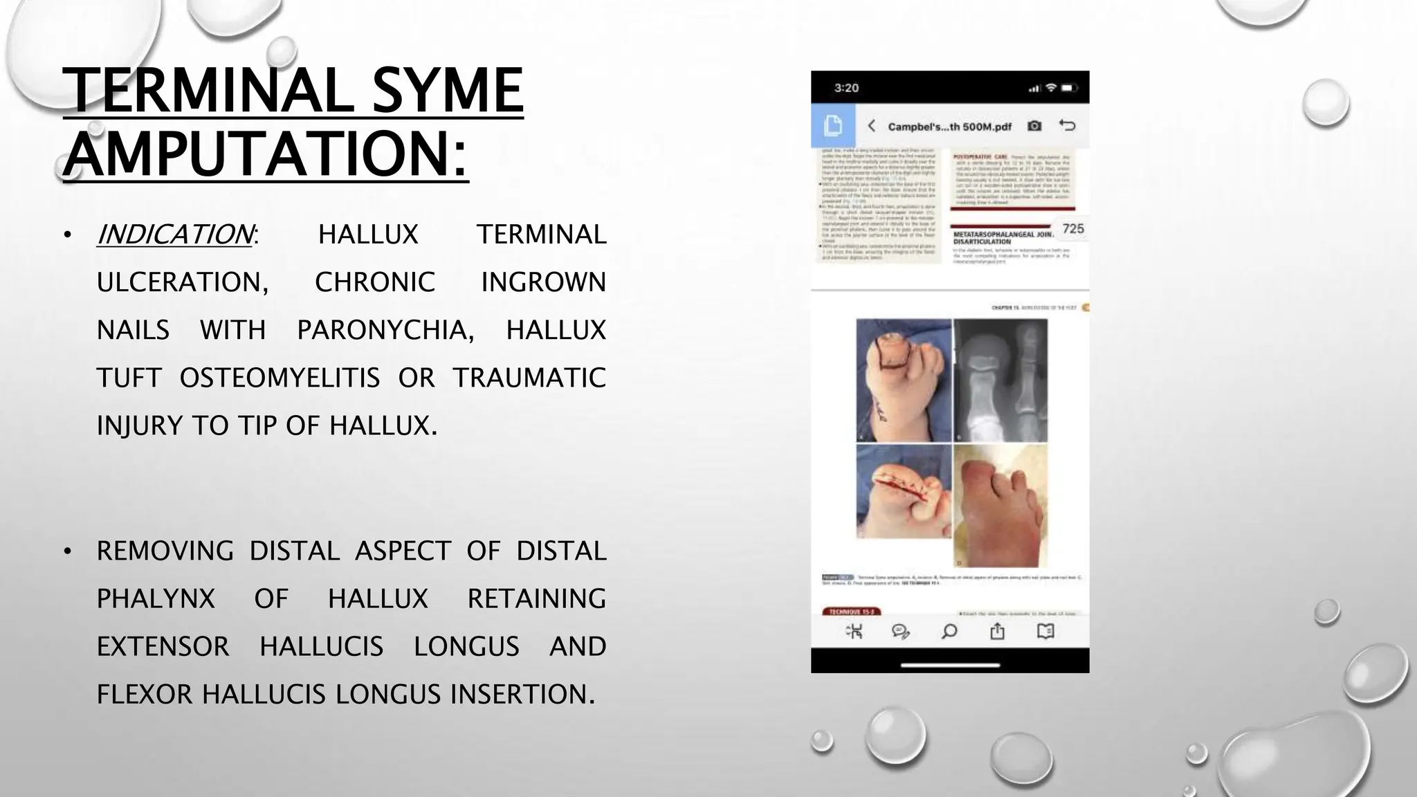 Amputations of foot and it's rehabilitation.pptx