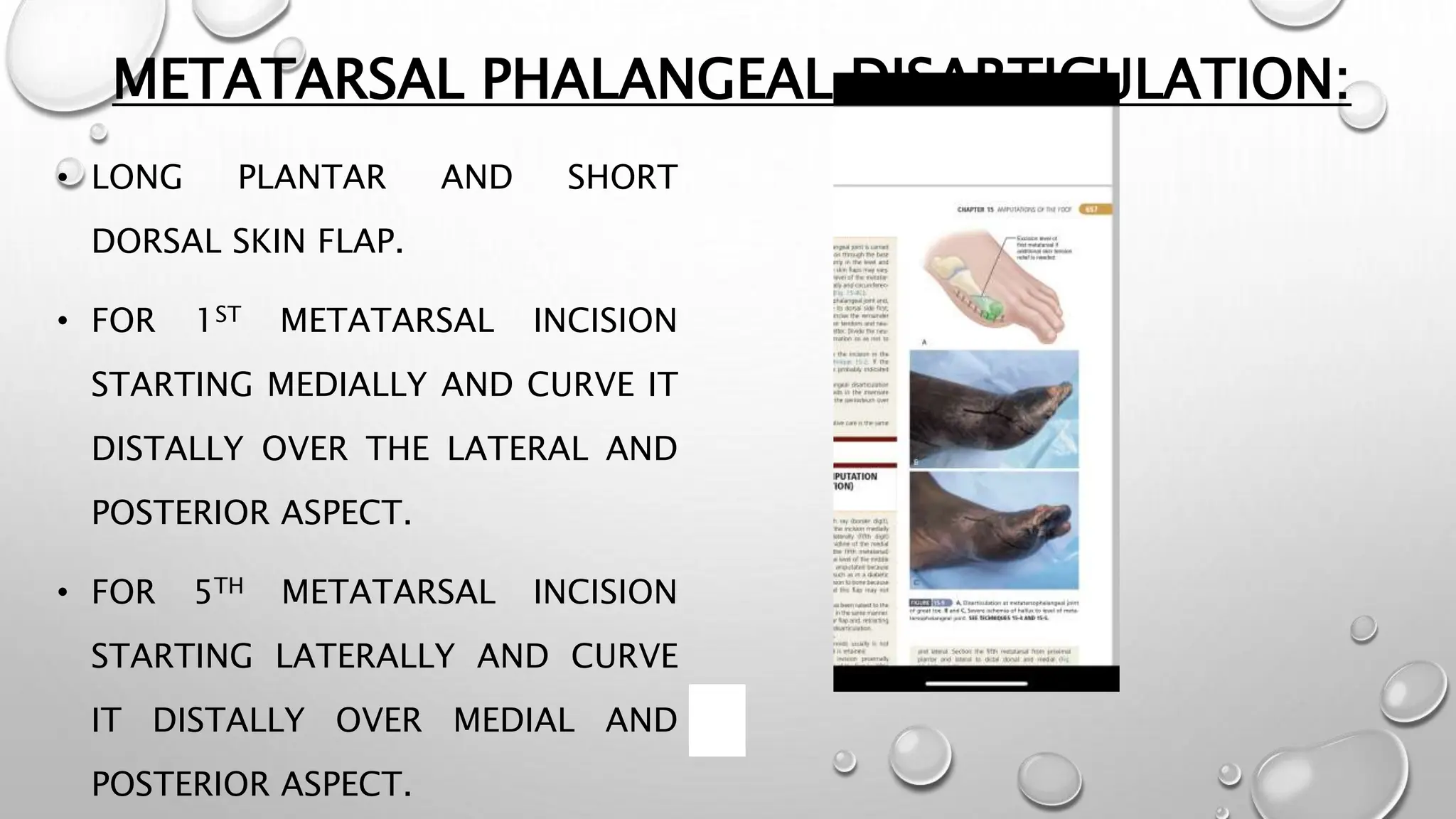Amputations of foot and it's rehabilitation.pptx