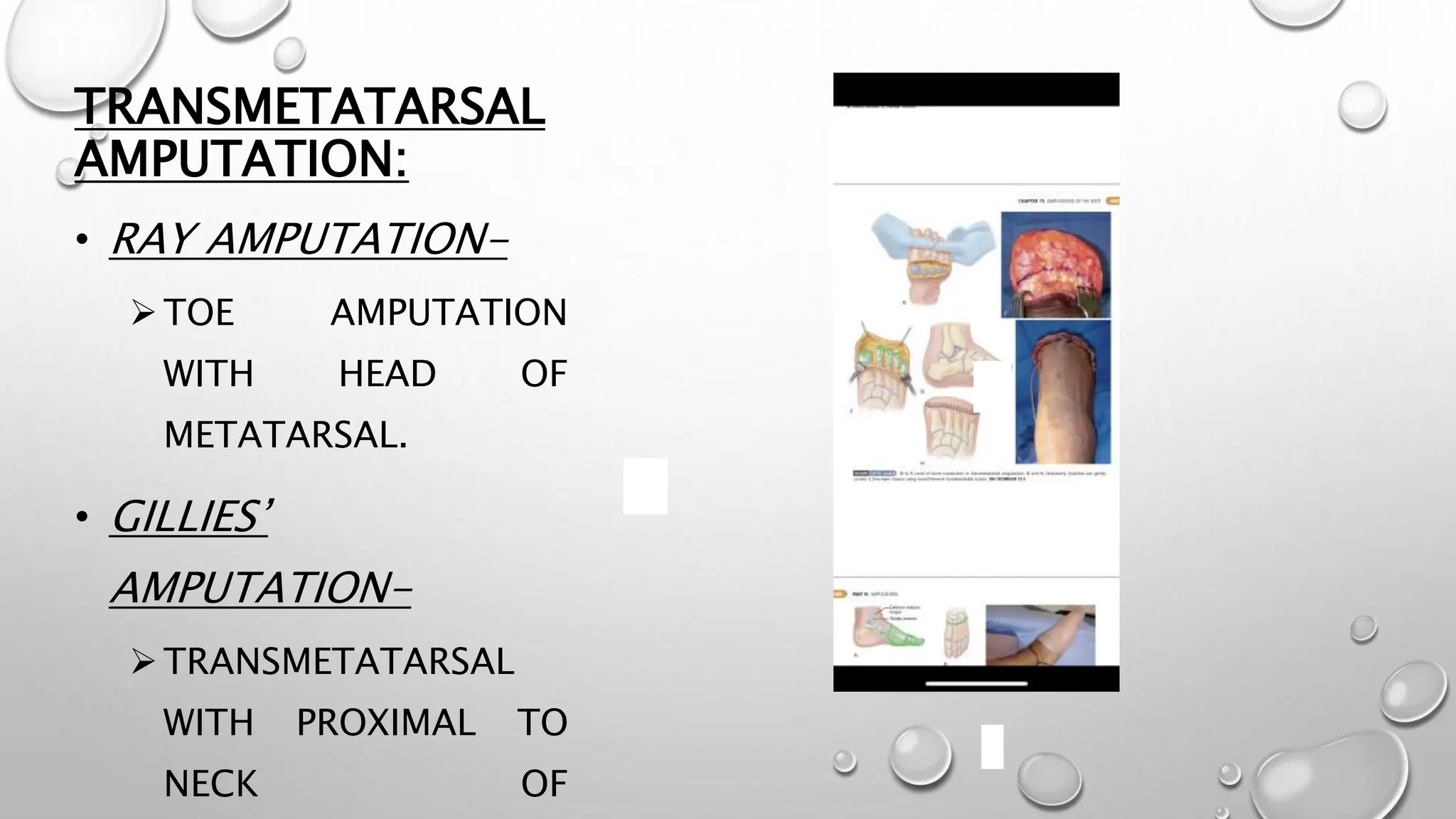 Amputations of foot and it's rehabilitation.pptx