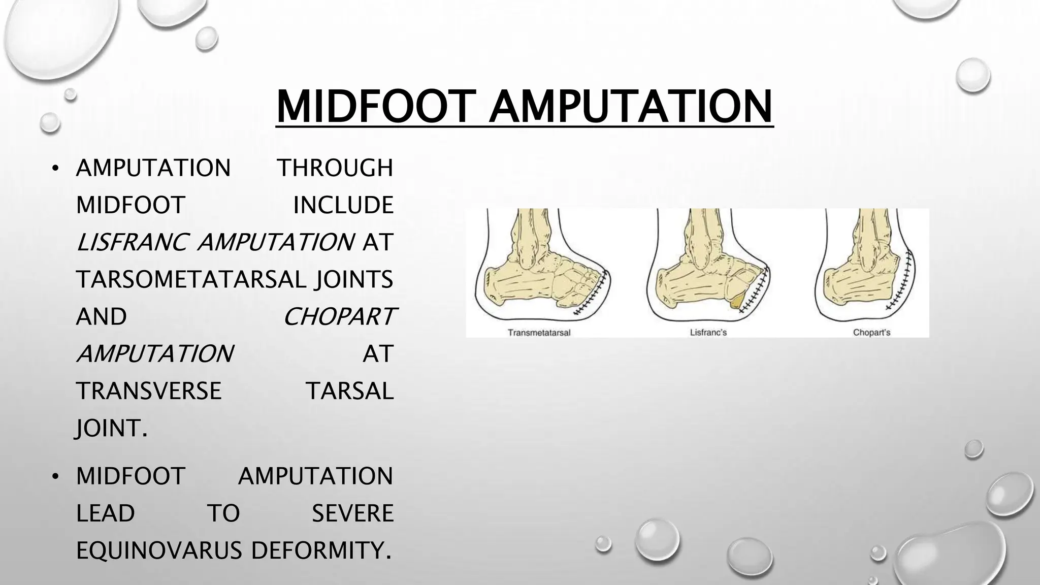 Amputations of foot and it's rehabilitation.pptx