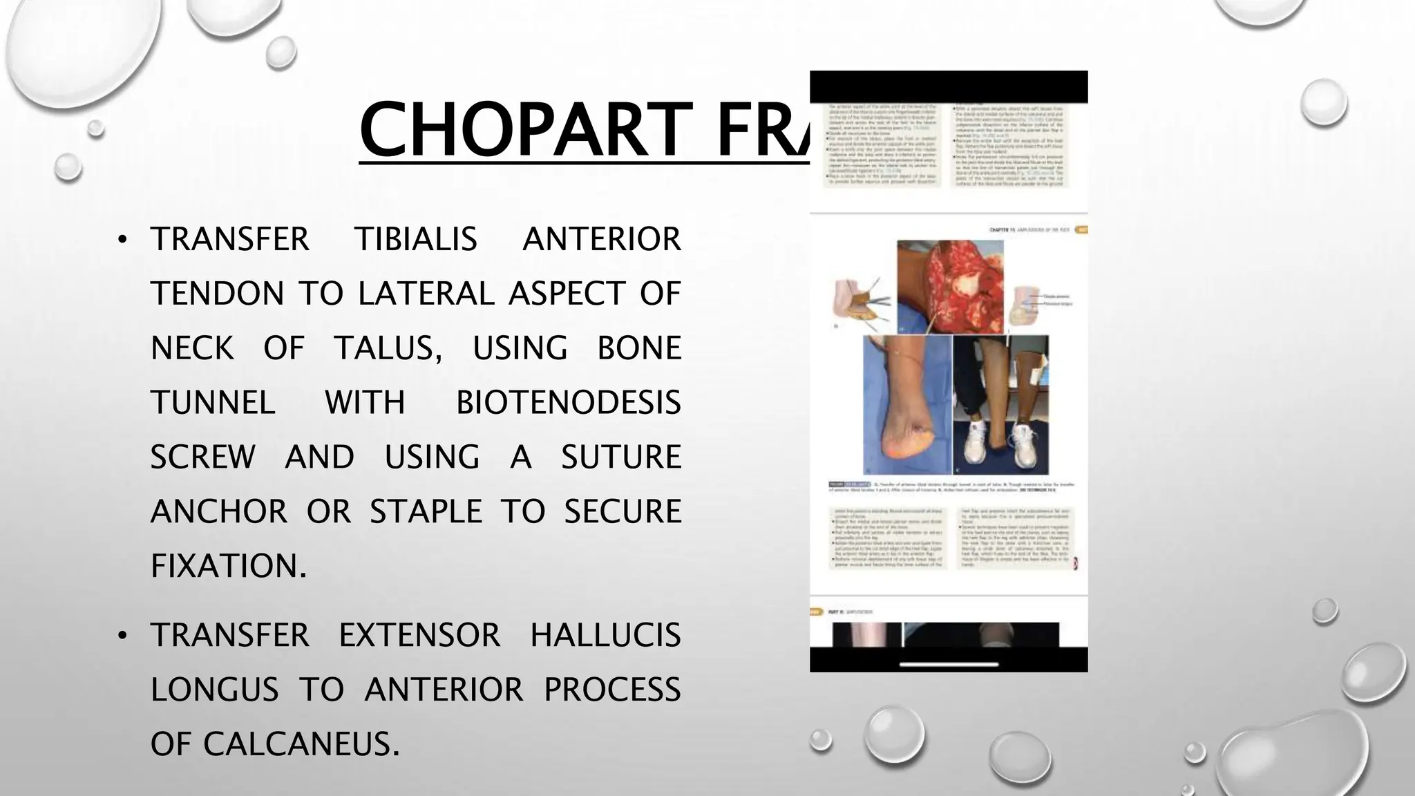Amputations of foot and it's rehabilitation.pptx