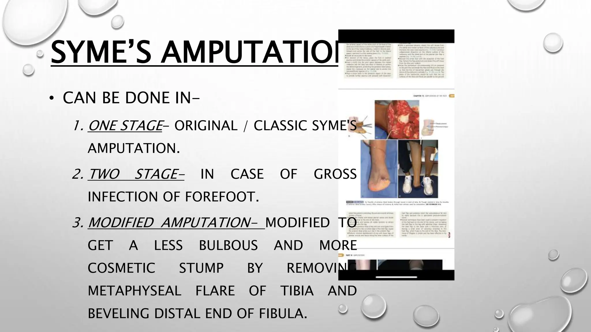 Amputations of foot and it's rehabilitation.pptx