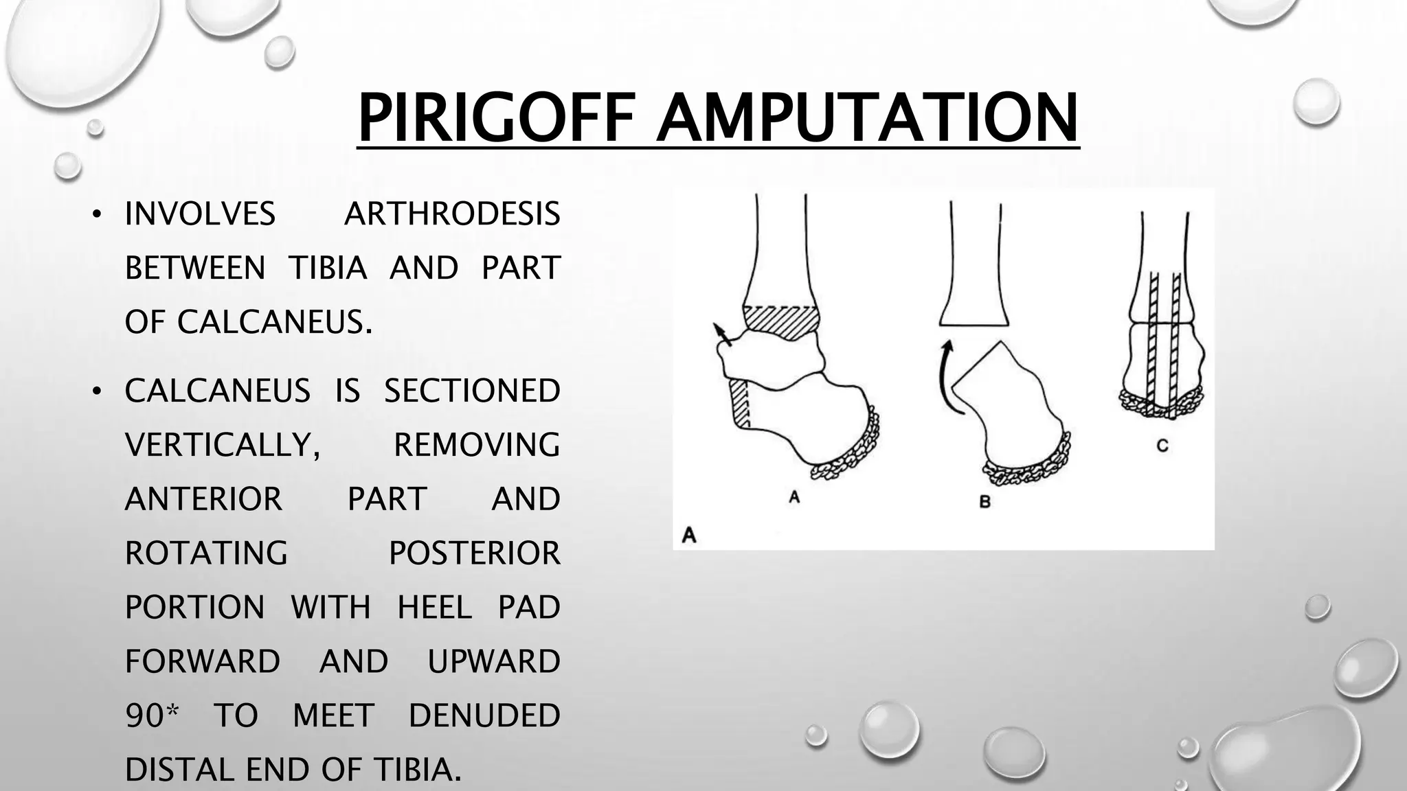 Amputations of foot and it's rehabilitation.pptx