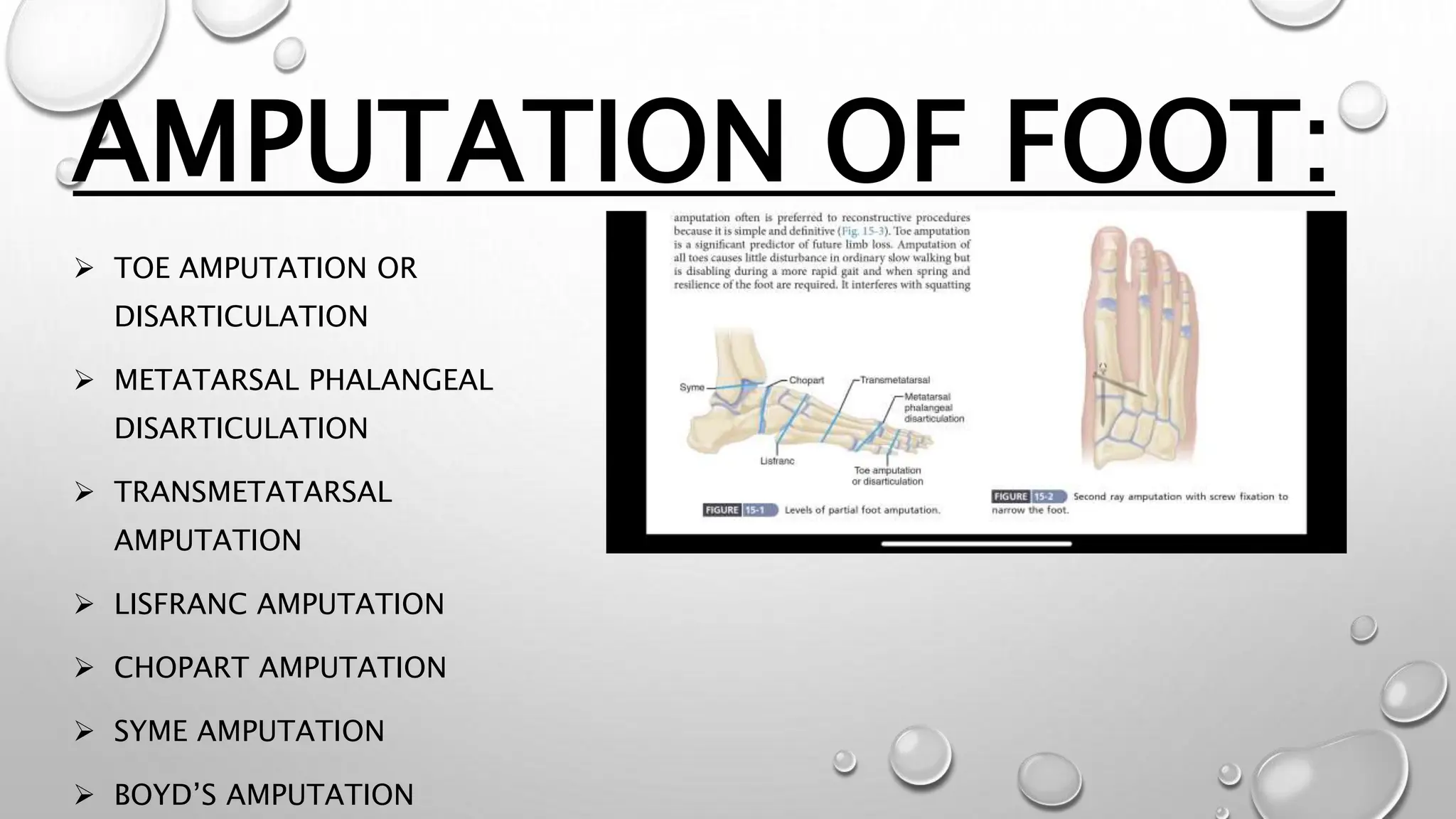 Amputations of foot and it's rehabilitation.pptx