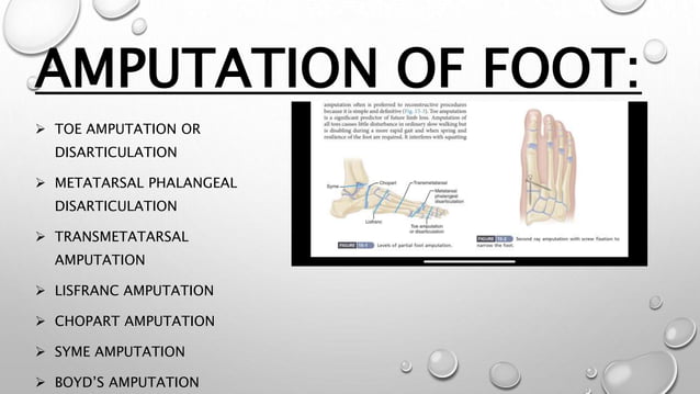 Amputations of foot and it's rehabilitation.pptx | Death, Injury, or ...