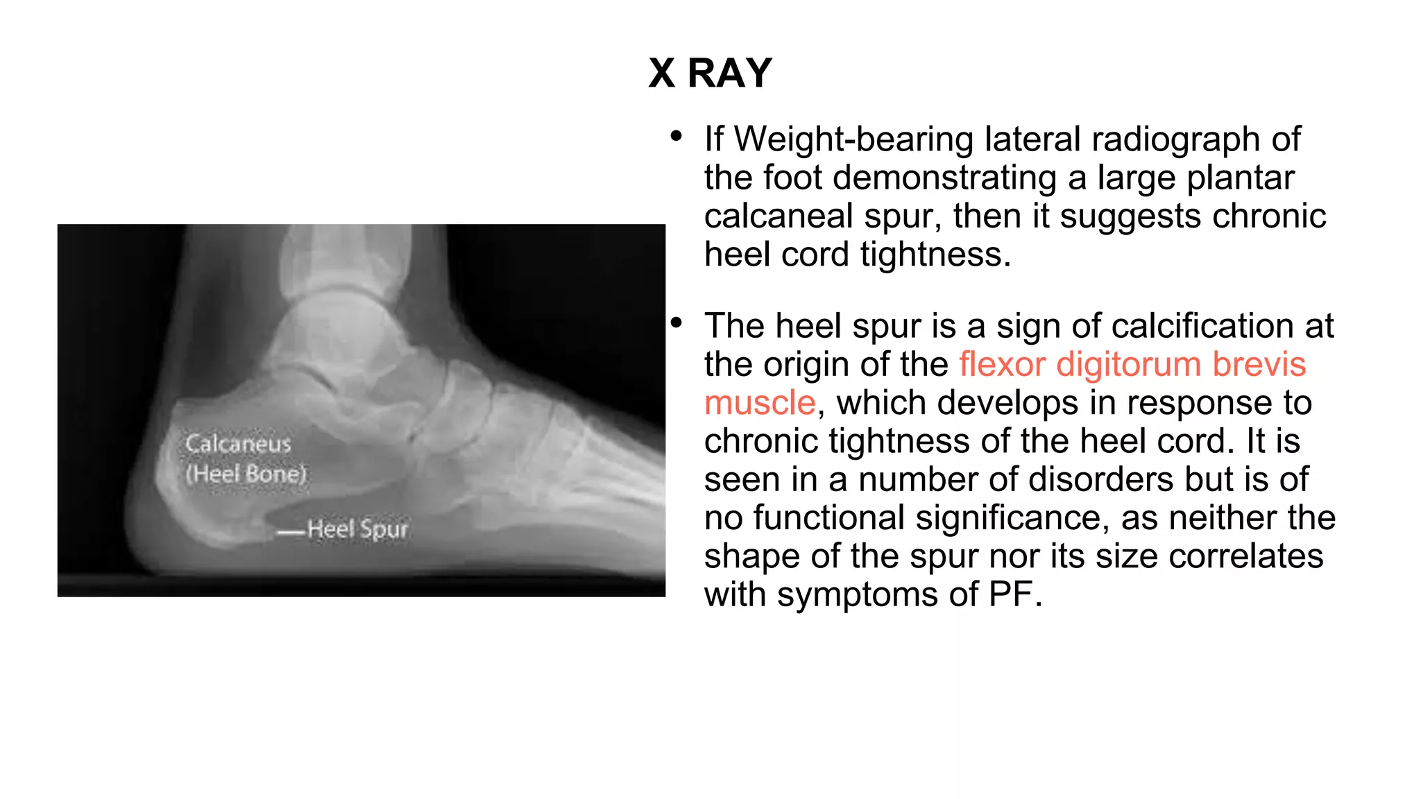 Arches of the foot and plantar fascitiis | PPTX