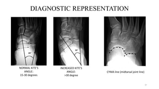 Biomechanics of Foot and Ankle complex, CP orthotic management &Tone ...