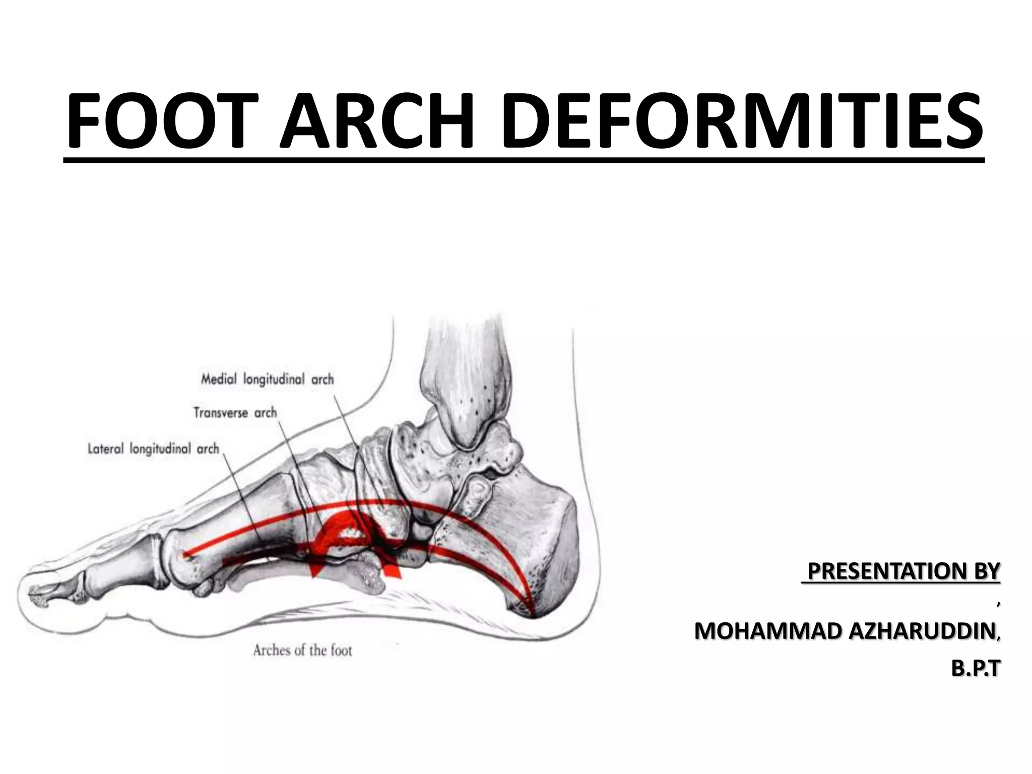 Foot arch deformities 2 | PPTX