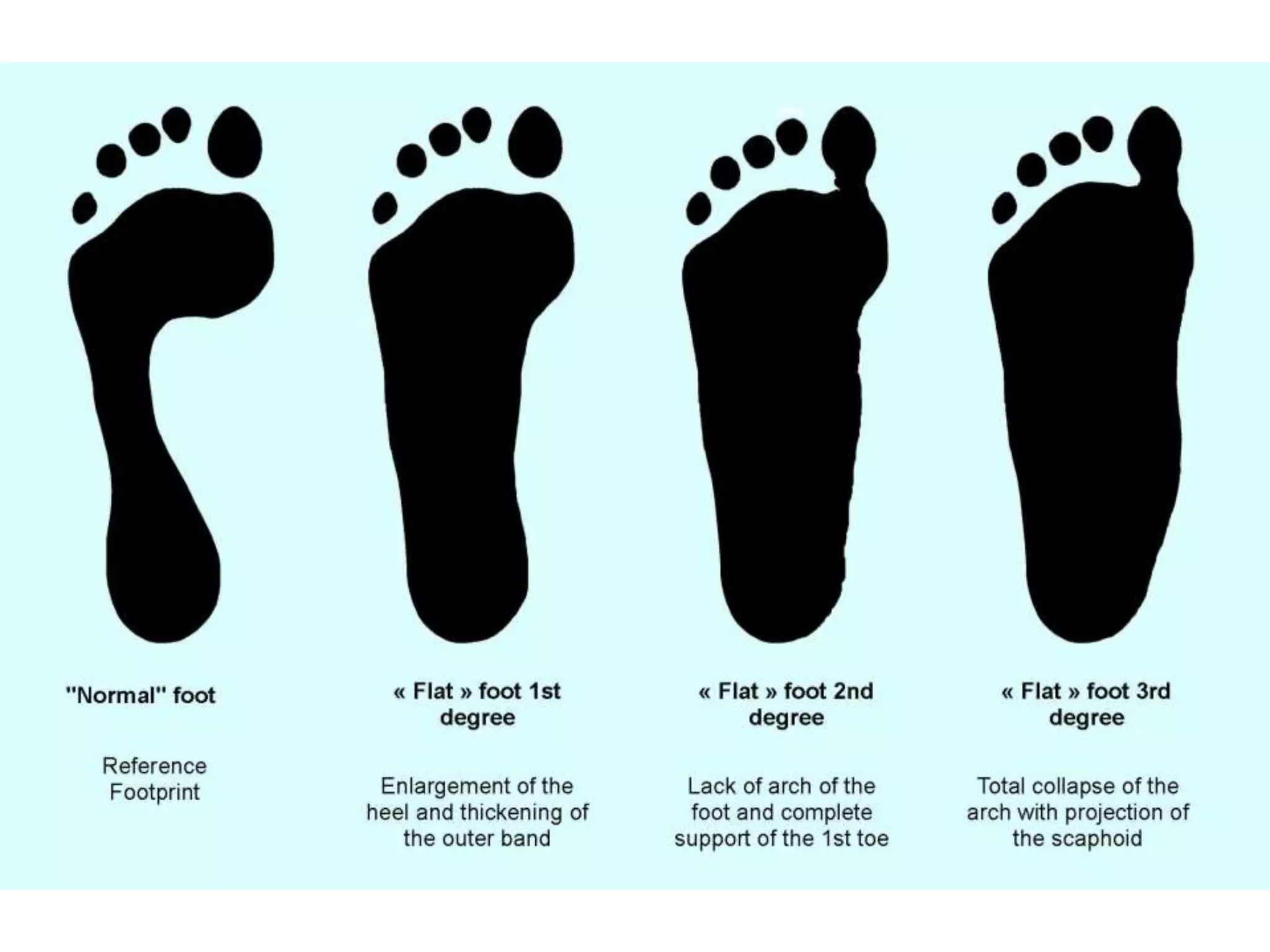 Foot arch deformities 2 | PPTX