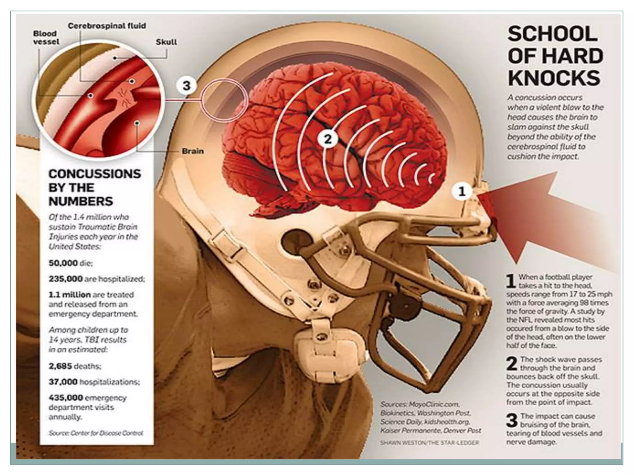 Football concussions | PPTX