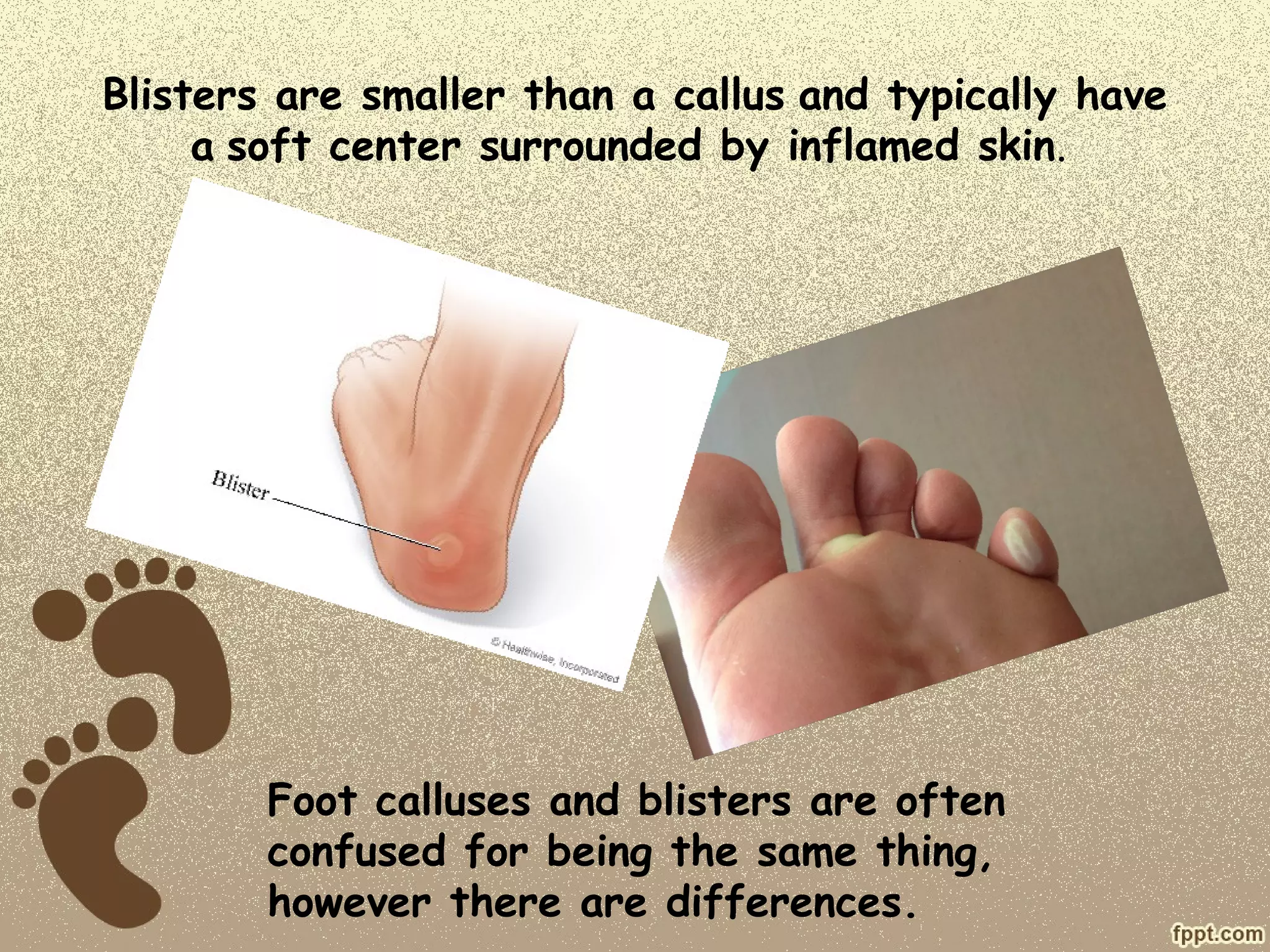 Foot corns, calluses & blister treatment | PPT