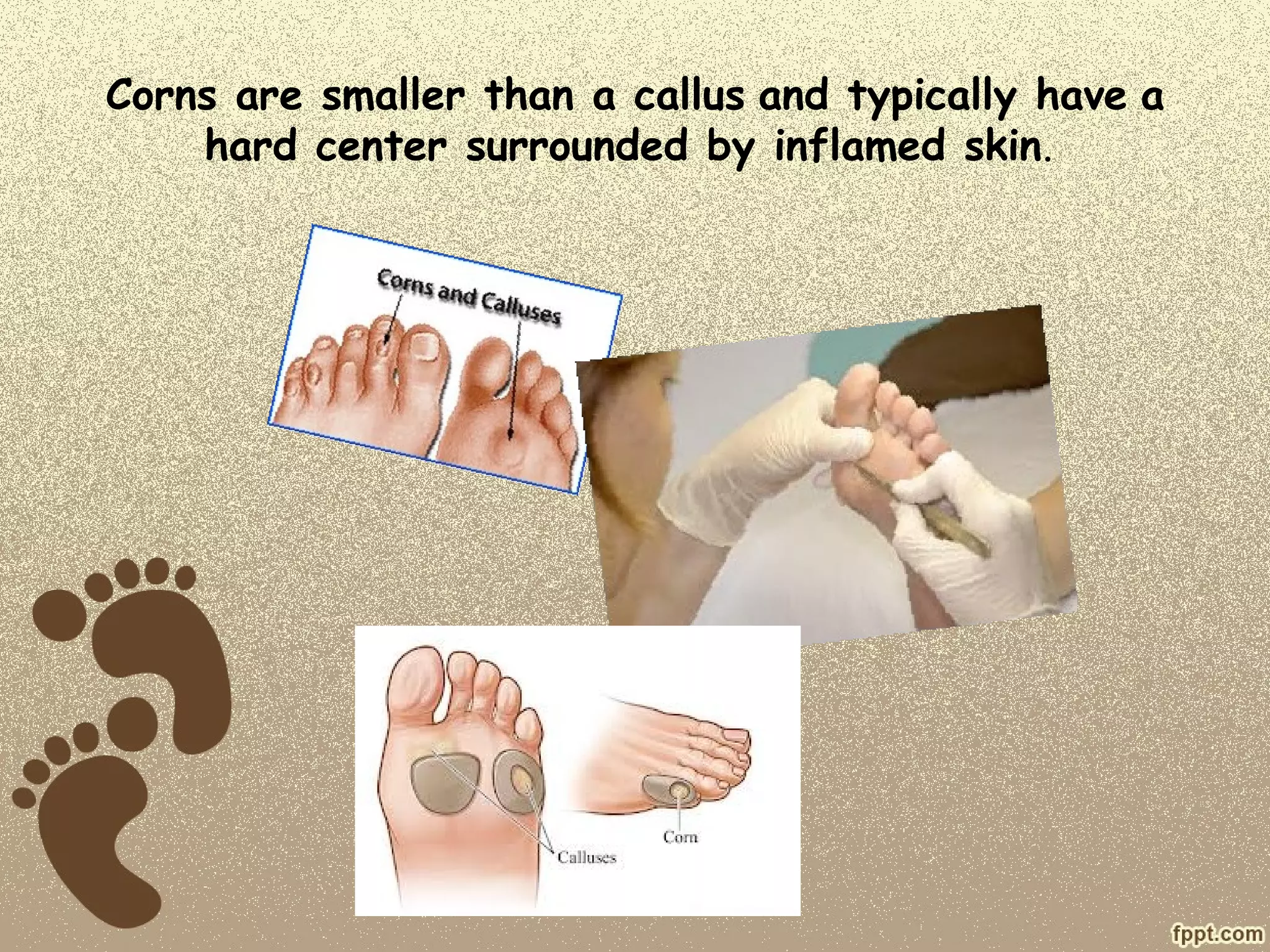 Foot corns, calluses & blister treatment | PPT