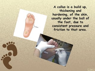 Foot corns, calluses & blister treatment | PPT