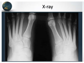 Foot Deformity.pptx