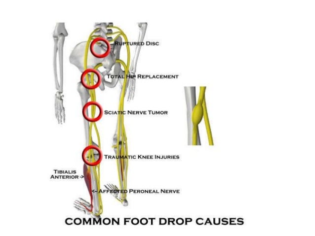 Foot drop