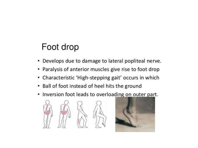 Foot drop | PPTX