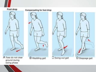 Foot drop | PPT